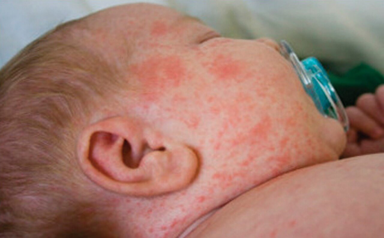Sarampo na criança: o que você precisa saber? - Instituto Villamil